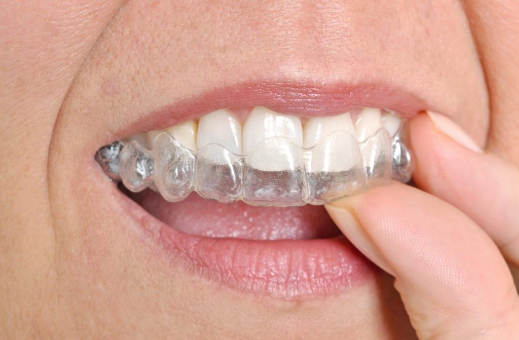Get Invisalign Braces in London from Qualified Invisalign® Providers ...